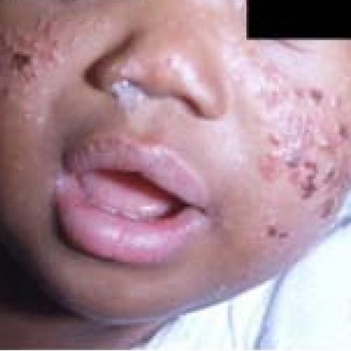 Atopic Dermatitis Images - JDDonline - Journal of Drugs in Dermatology