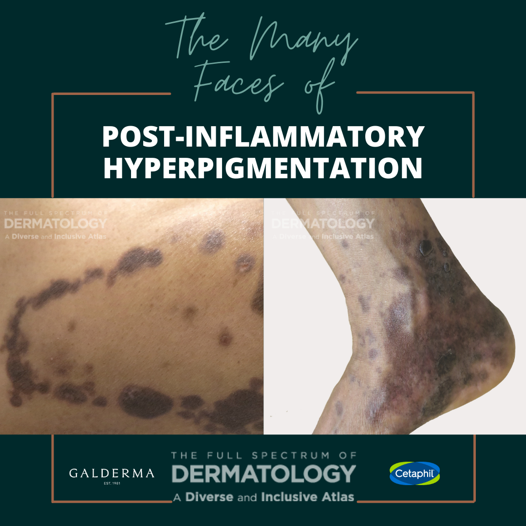 The Many Faces of Post-Inflammatory Hyperpigmentation (PIH) - JDDonline ...