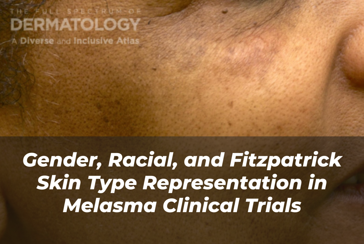 Gender, Racial, and Fitzpatrick Skin Type Representation in Melasma ...