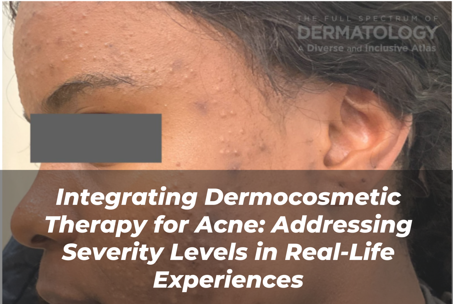 Integrating Dermocosmetic Therapy for Acne: Addressing Severity Levels ...